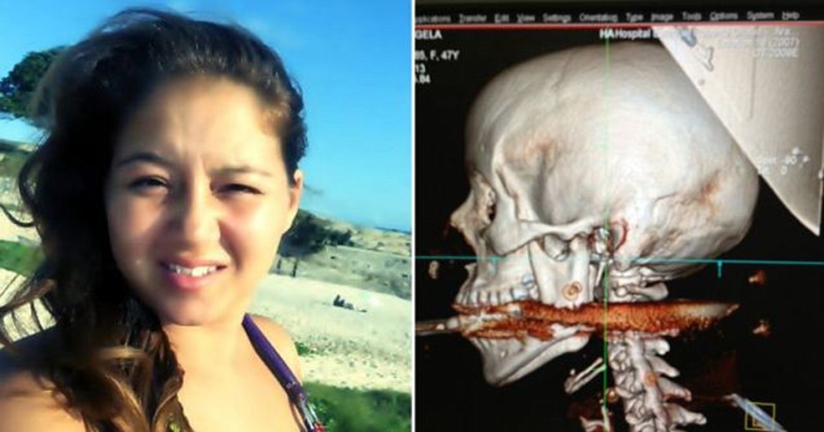 Su marido le clavó un arpón en la boca y sobrevivió | 24con